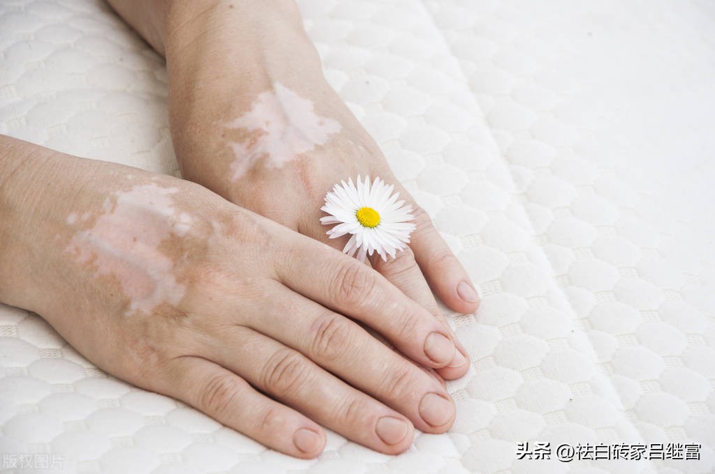 Slight vitiligo at the beginning, what is the disease?How to judge fast ...