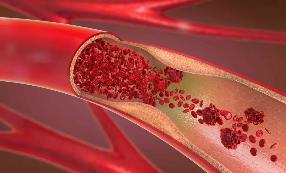 Died 12 days after twisted foot - iNEWS