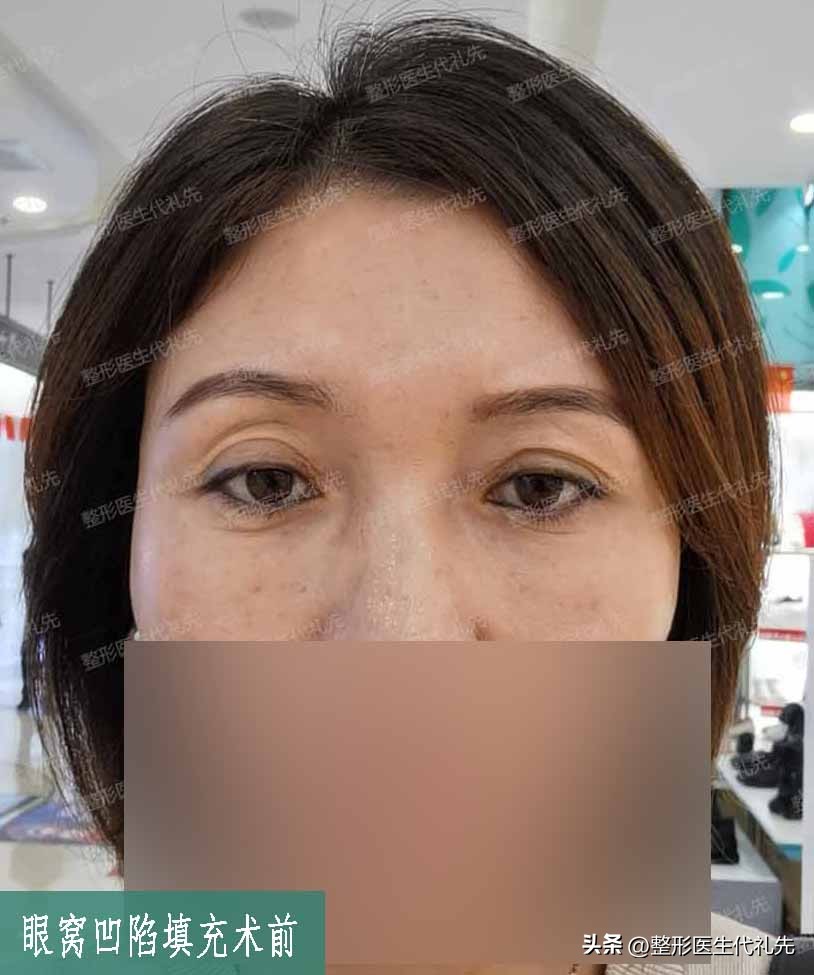 It's been 11 months since I did the eye socket fat gel filling, and I ...