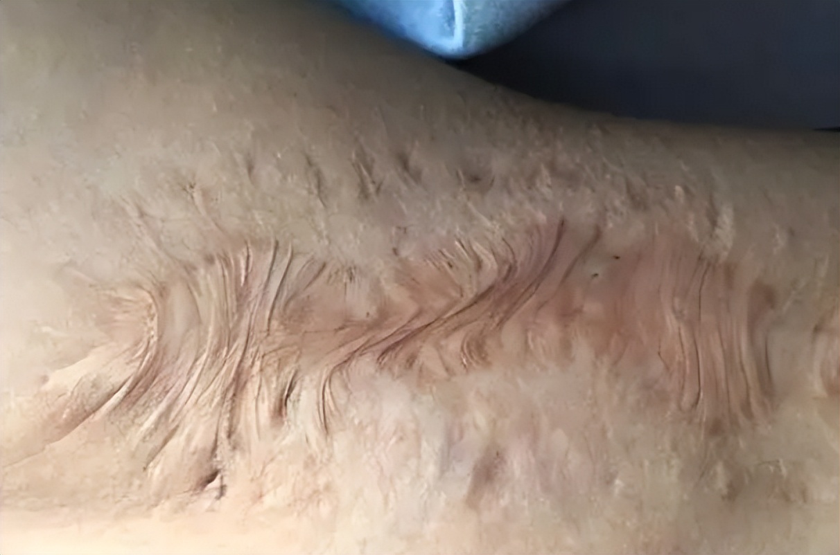 Can burn scars be completely removed?Can an injury scar be completely ...