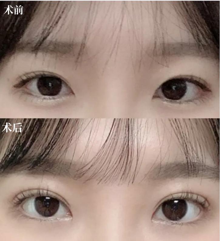 What is Japanese double eyelid - iNEWS
