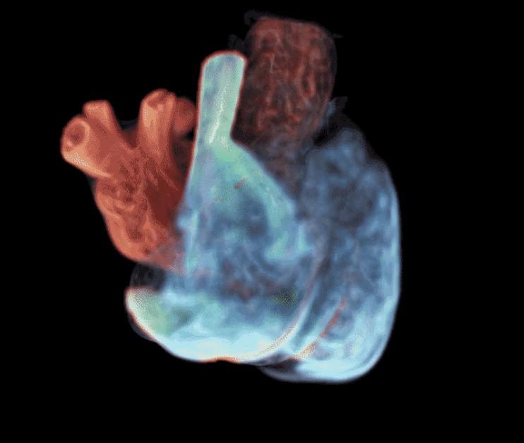 Digital twin - Siemens and living heart project in the heart field - iNEWS