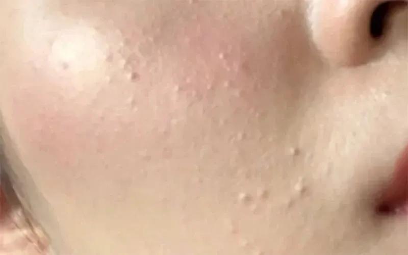 Shu Shan: Causes of closed acne - iNEWS