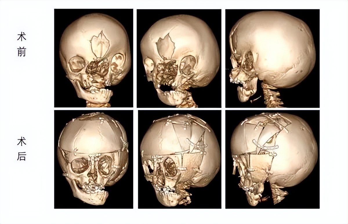 Severe craniofacial deformity in a 5-year-old girl, successfully ...