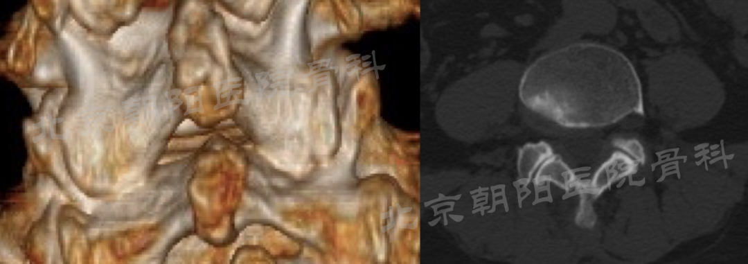 20 cases of UBE surgery learning curve - iNEWS