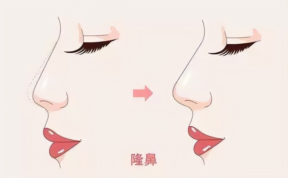 Does rhinoplasty just blindly increase the height of the root and the ...