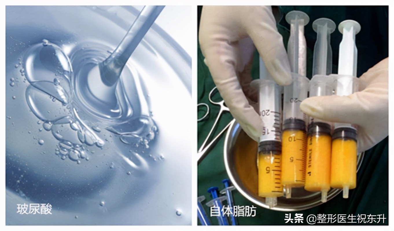 Facial filling common "5" places, teach you 2 methods, say goodbye to ...