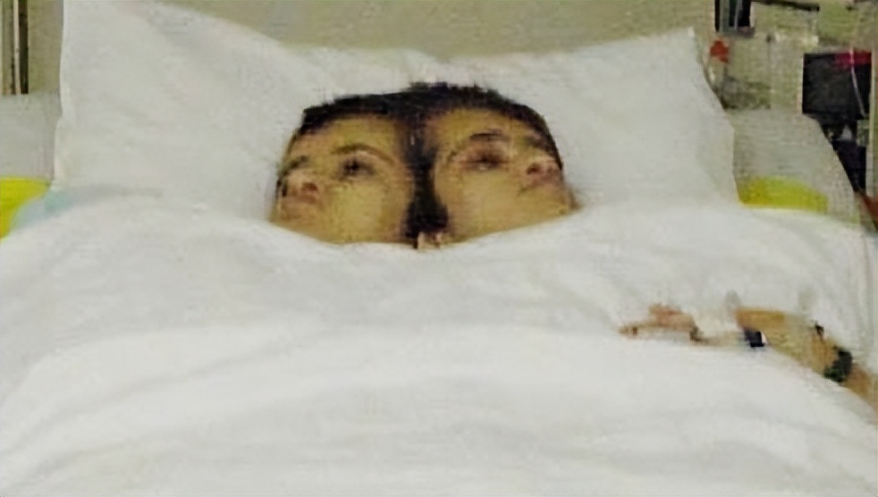 Conjoined twins have 22 children? Brothers separated by surgery ...