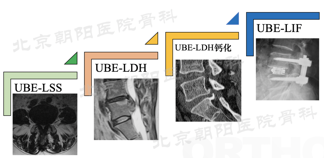 20 cases of UBE surgery learning curve - iNEWS