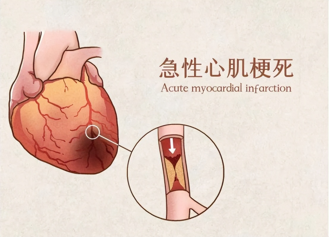There are signs in the early stage of myocardial infarction, and ...