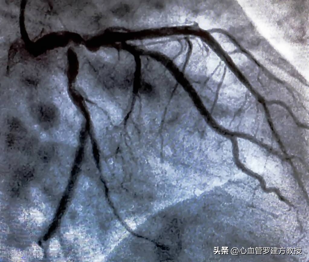 How is coronary angiography done?When does it need to be done?Who can't ...