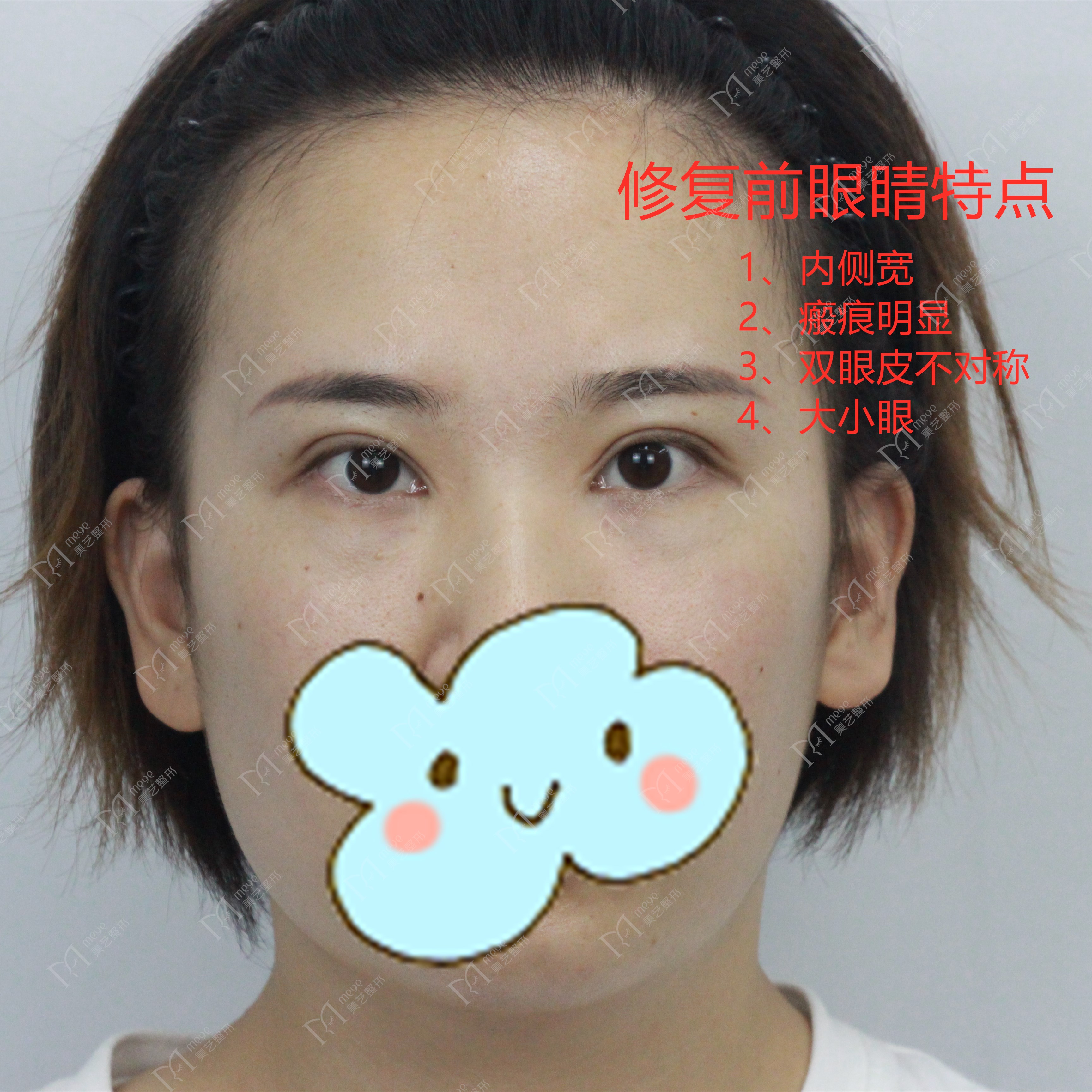 How to improve the shape of double eyelids? The poor shape is mainly ...