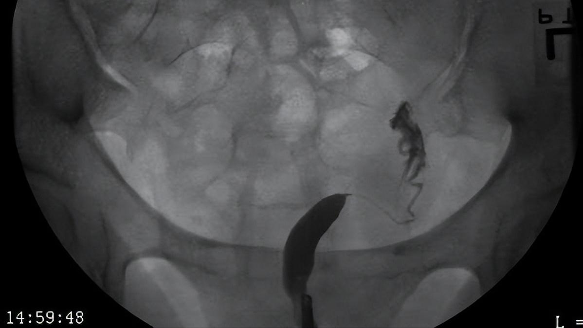 How much do you know about unicornuate uterus? - iMedia