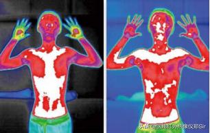 Comparison of the application and curative effect of medical infrared ...