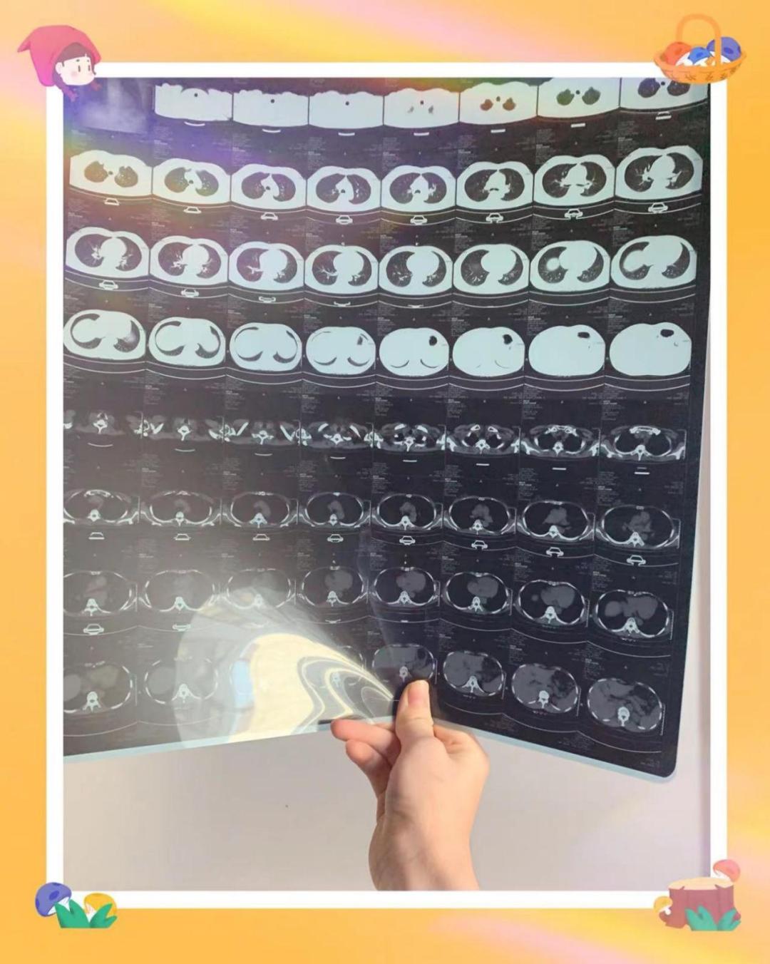 How are "CT" films made?One minute science tells you, please collect ...