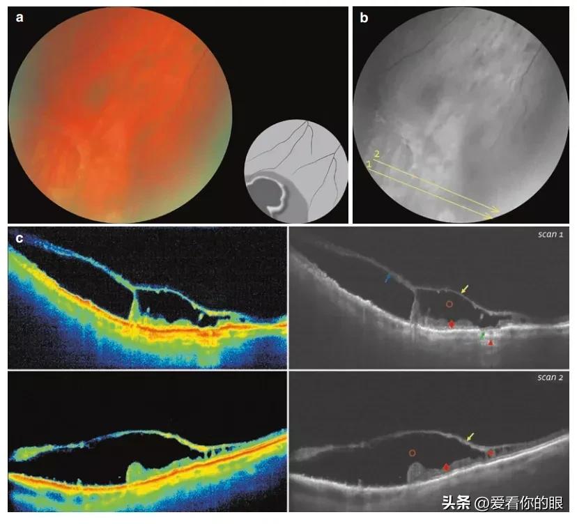 Talk about "retinal degeneration" that every myopic patient should know ...
