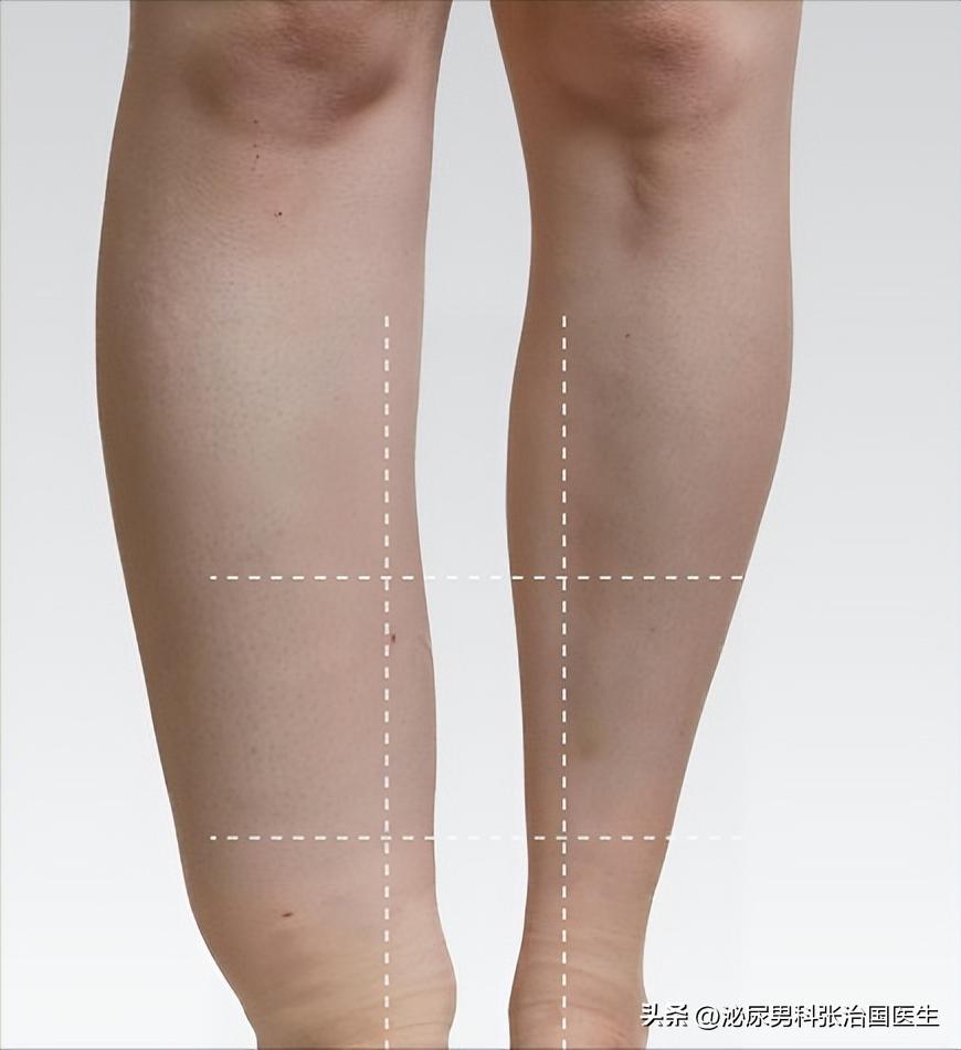 What happens to edema after circumcision surgery? How to speed up ...