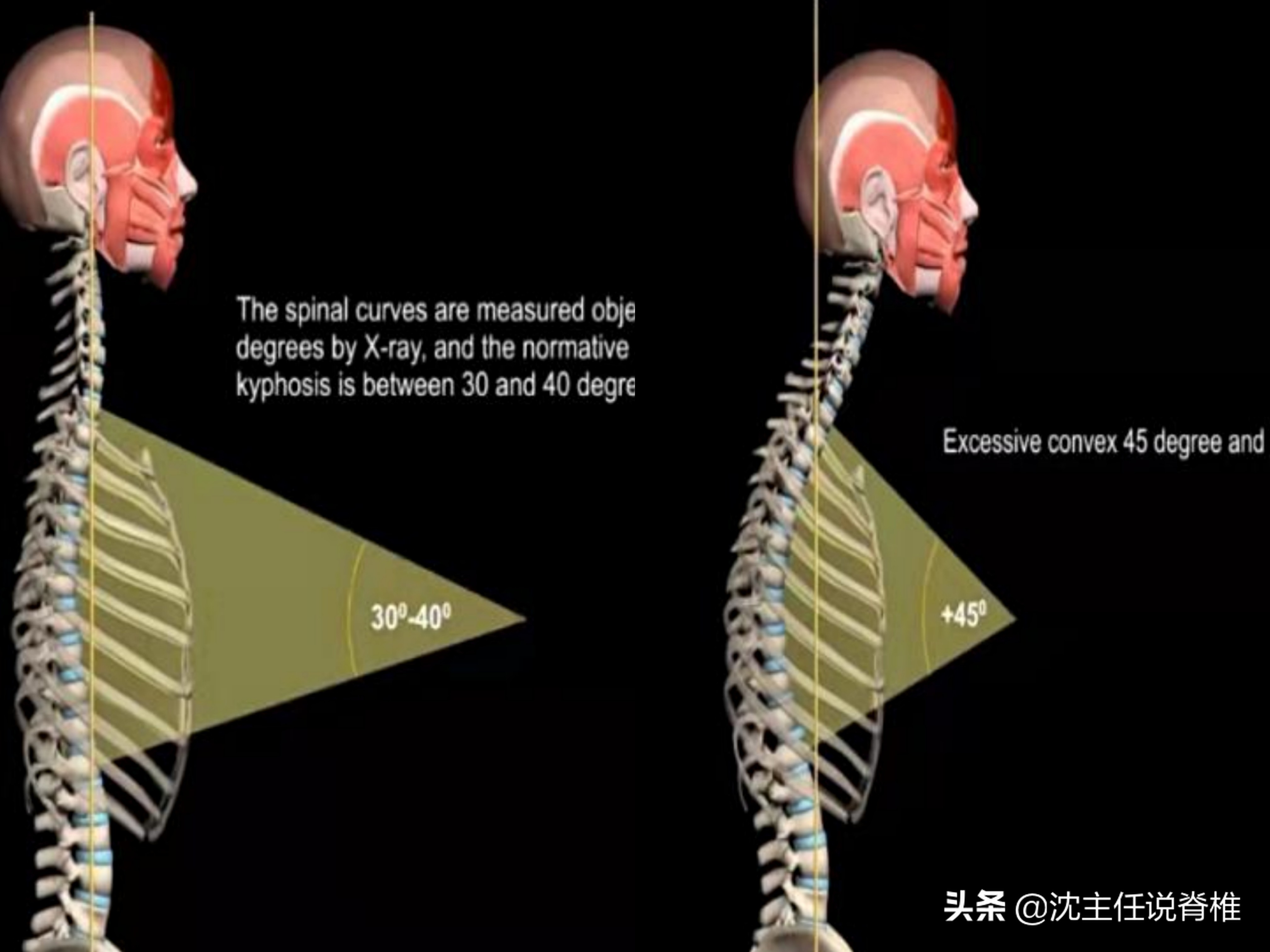Humpback affects posture and temperament, how can I improve it? - iNEWS