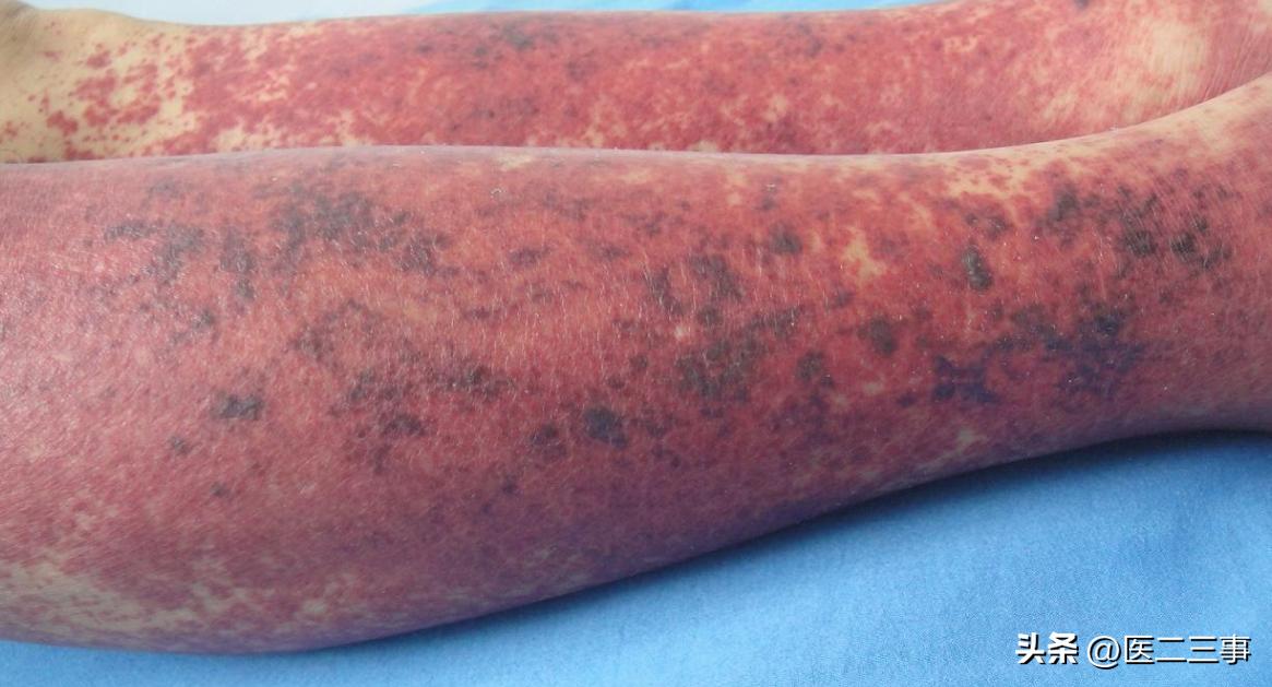 A patient with skin rash, blood in stool and fever - iMedia