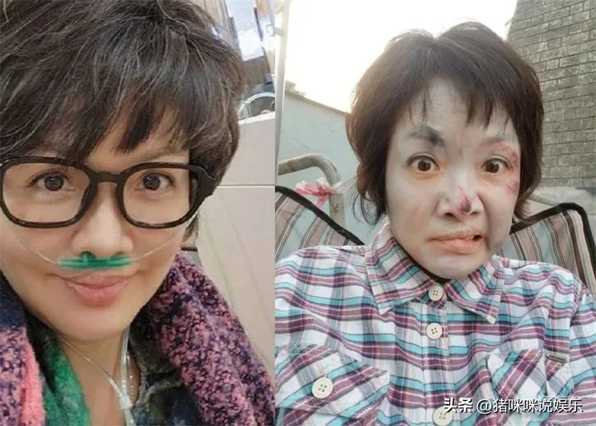 After being disfigured in a car accident and falling into depression ...