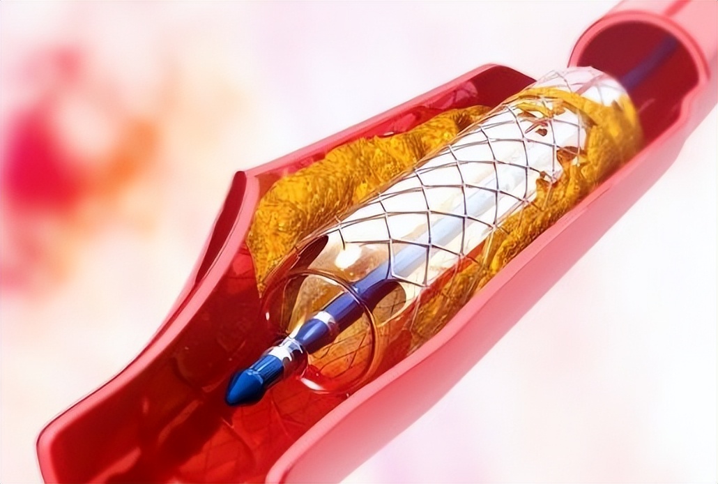 How many years can you live after a heart stent is installed?The doctor ...