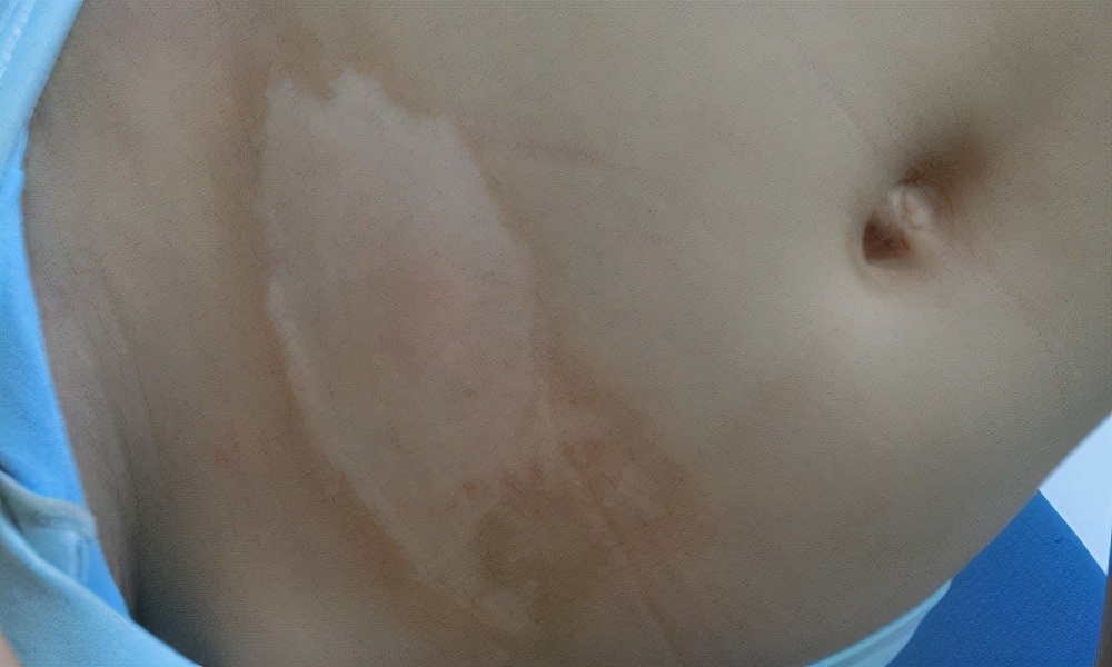 Fast!8-year-old boy with extensive vitiligo took only a few months from ...