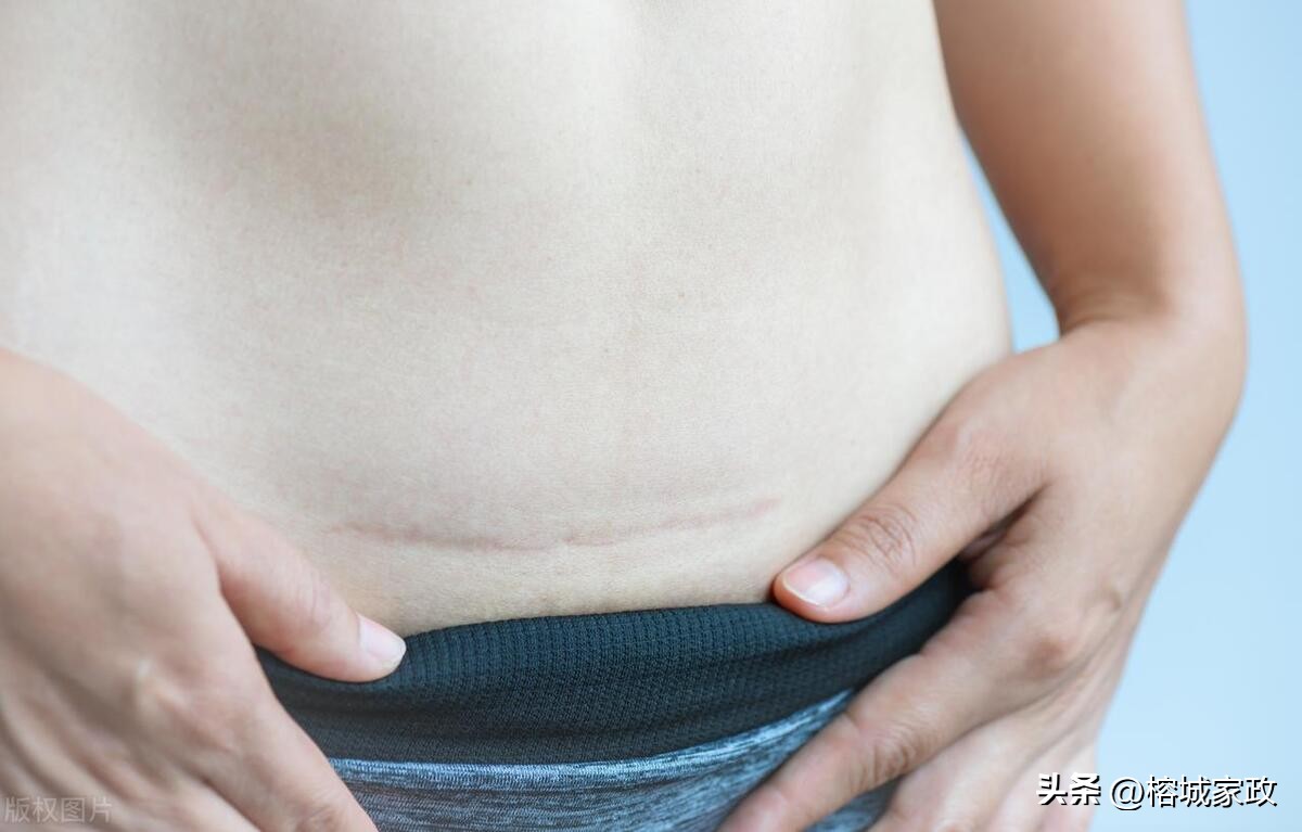 Why does the incision of the puerpera keep itching after caesarean ...