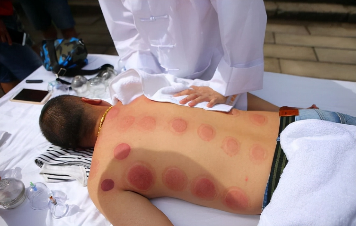 Can cupping detoxify?What is the black mark after cupping?It's not too ...