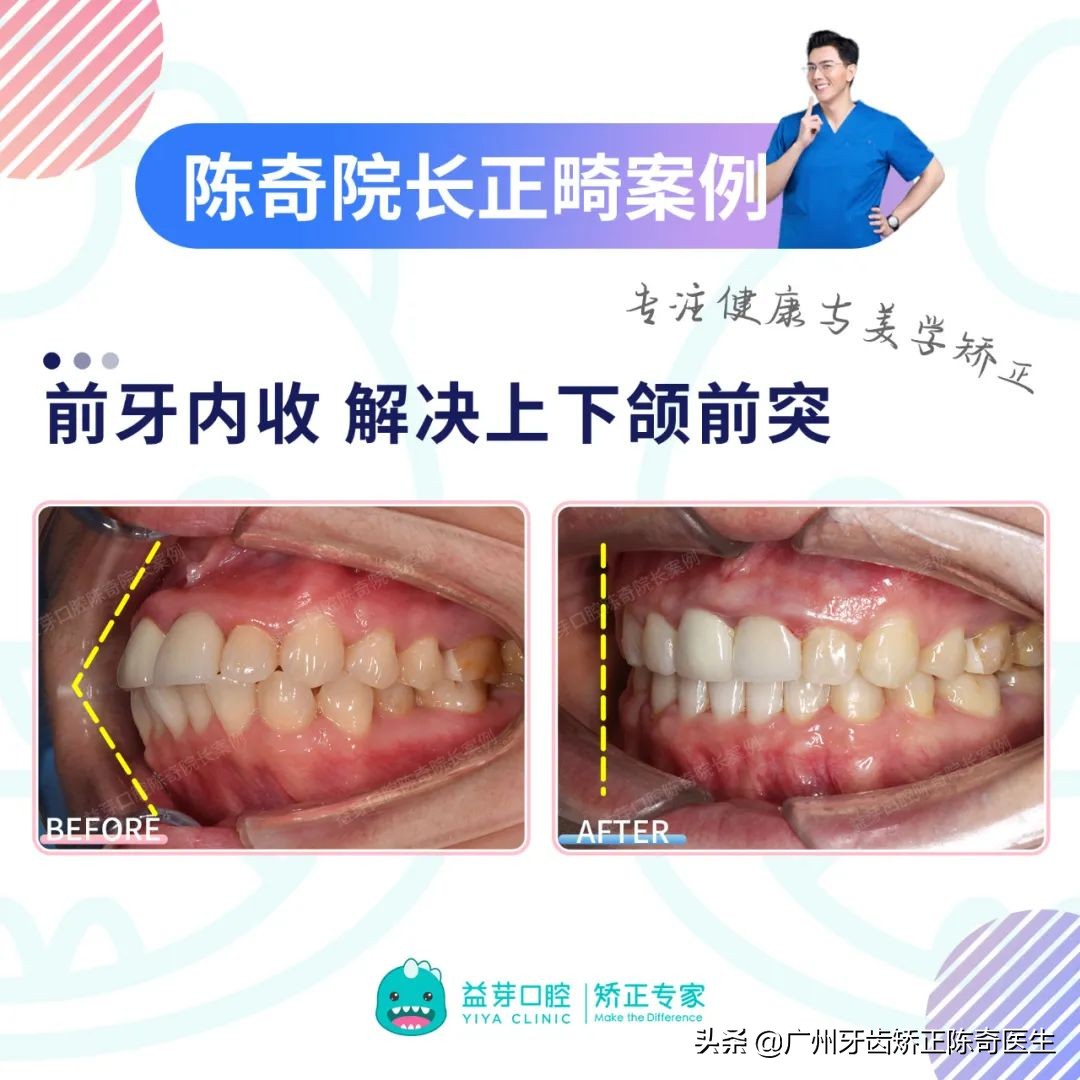 Super-difficult bony protrusion, can the chin be corrected in an older ...