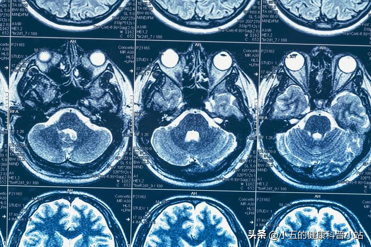 Indobufen is a new antiplatelet drug, how is it different from aspirin ...