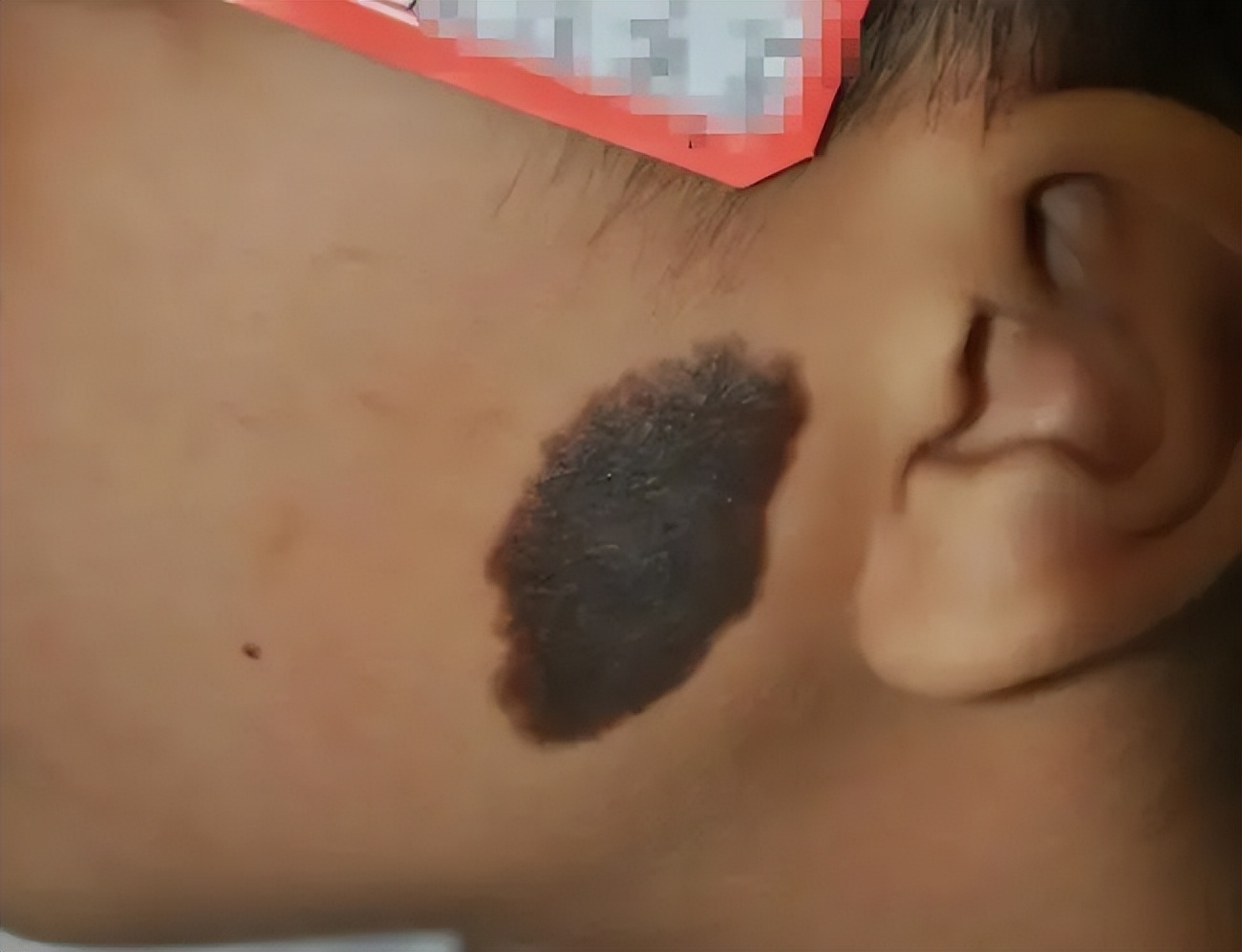 How to remove birthmarks on face?How to get rid of birthmarks fast - iNEWS