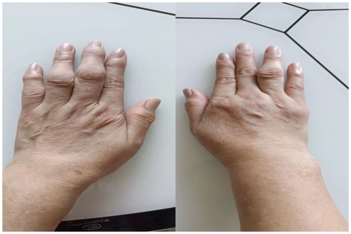 Rheumatoid arthritis complicated by polyarticular cysts, the treatment ...