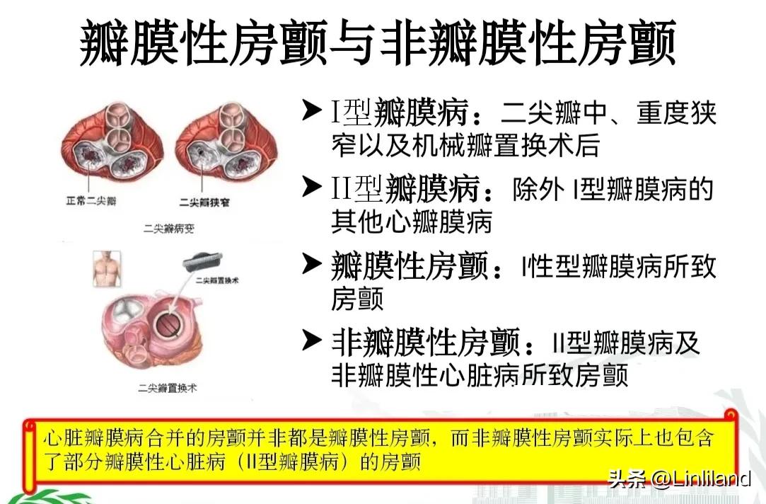 The anticoagulation treatment of atrial fibrillation is exquisite, and ...
