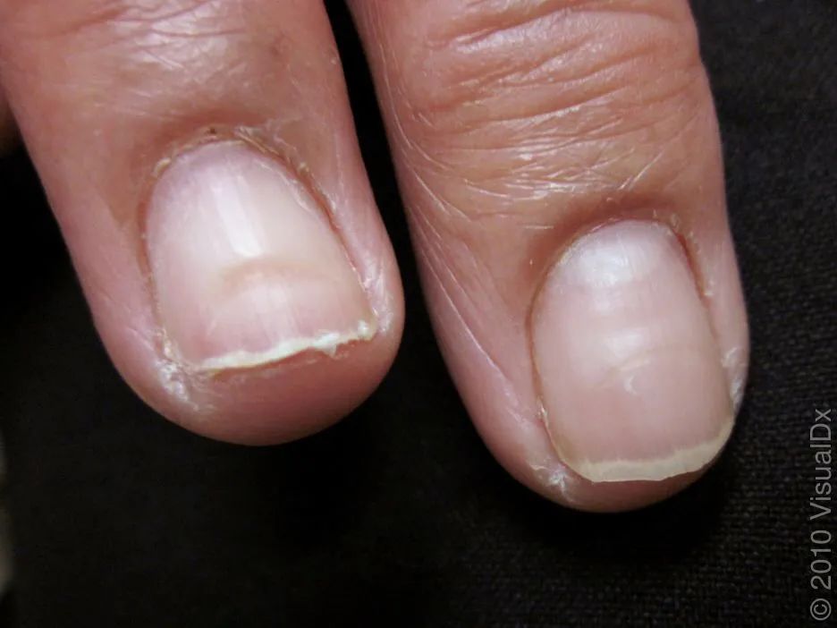 Are abnormal appearances on the nails a sign of disease? - iNEWS