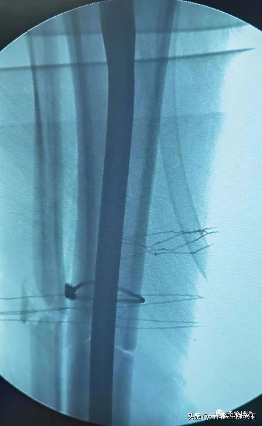 This week's tibial lock nails are available every day, seemingly simple ...