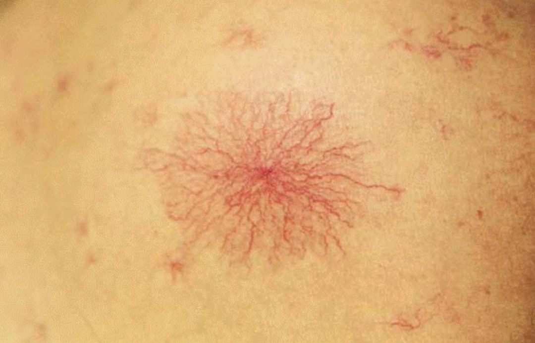 Liver problems, skin can not hide?There are 4 abnormal symptoms on the ...