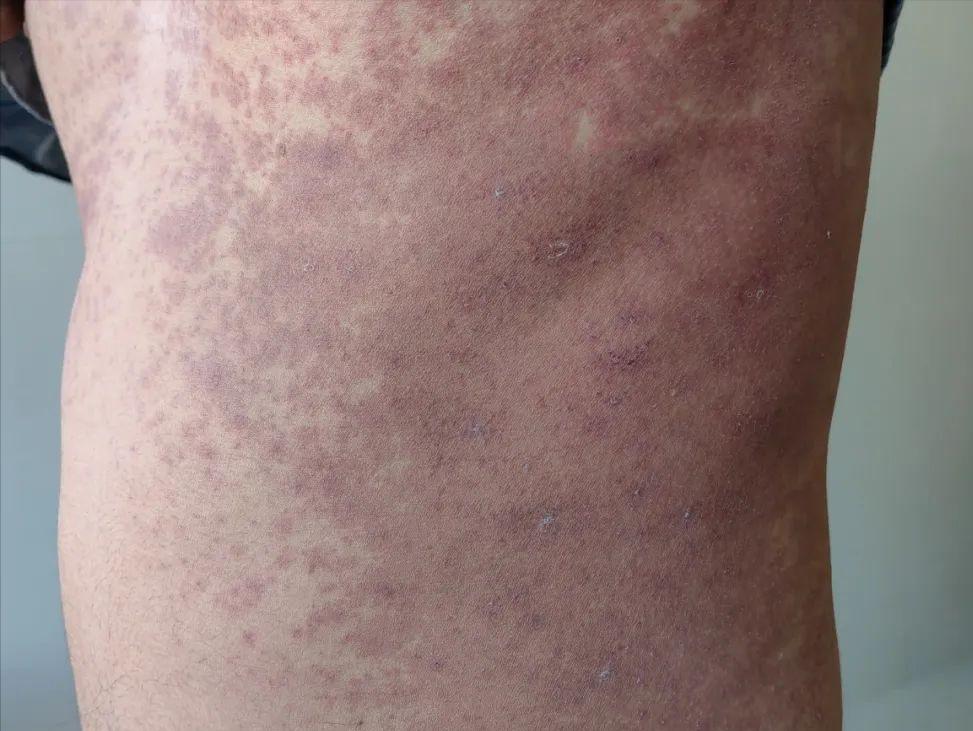 Generalized erythema multiforme, how to cause it? - iNEWS