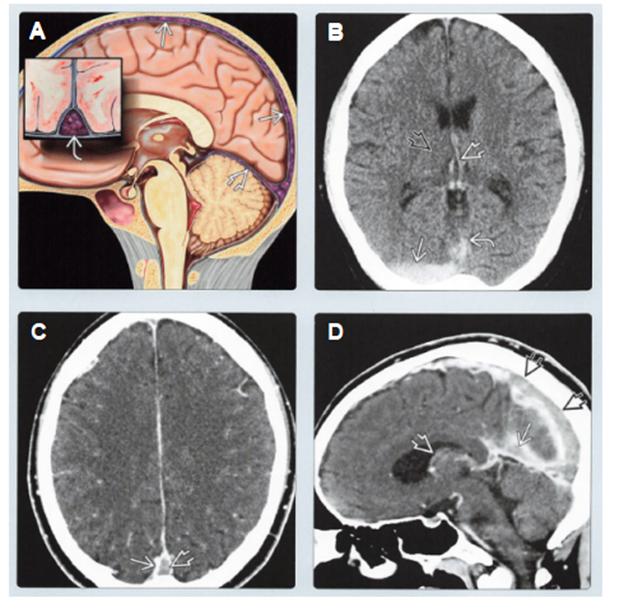 Anatomy and classification of cerebral venous thrombosis - iMedia