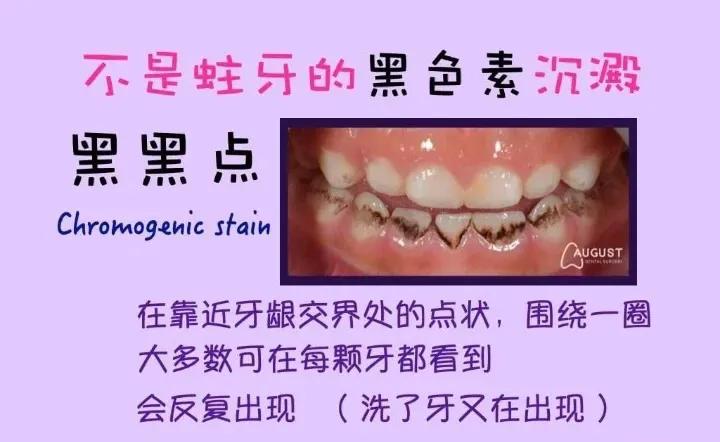 What should I do if my baby has black teeth? - iNEWS