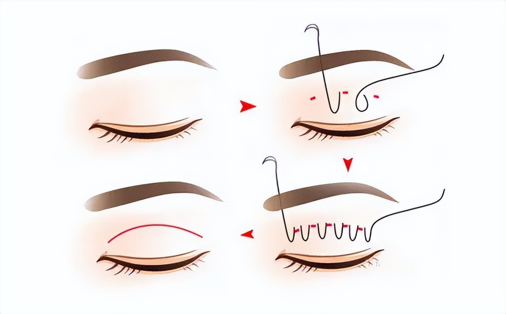 What thread is used to bury the double eyelid? - iNEWS