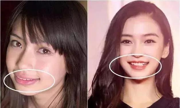 Celebrity teeth before and after comparison photos!comparable to ...