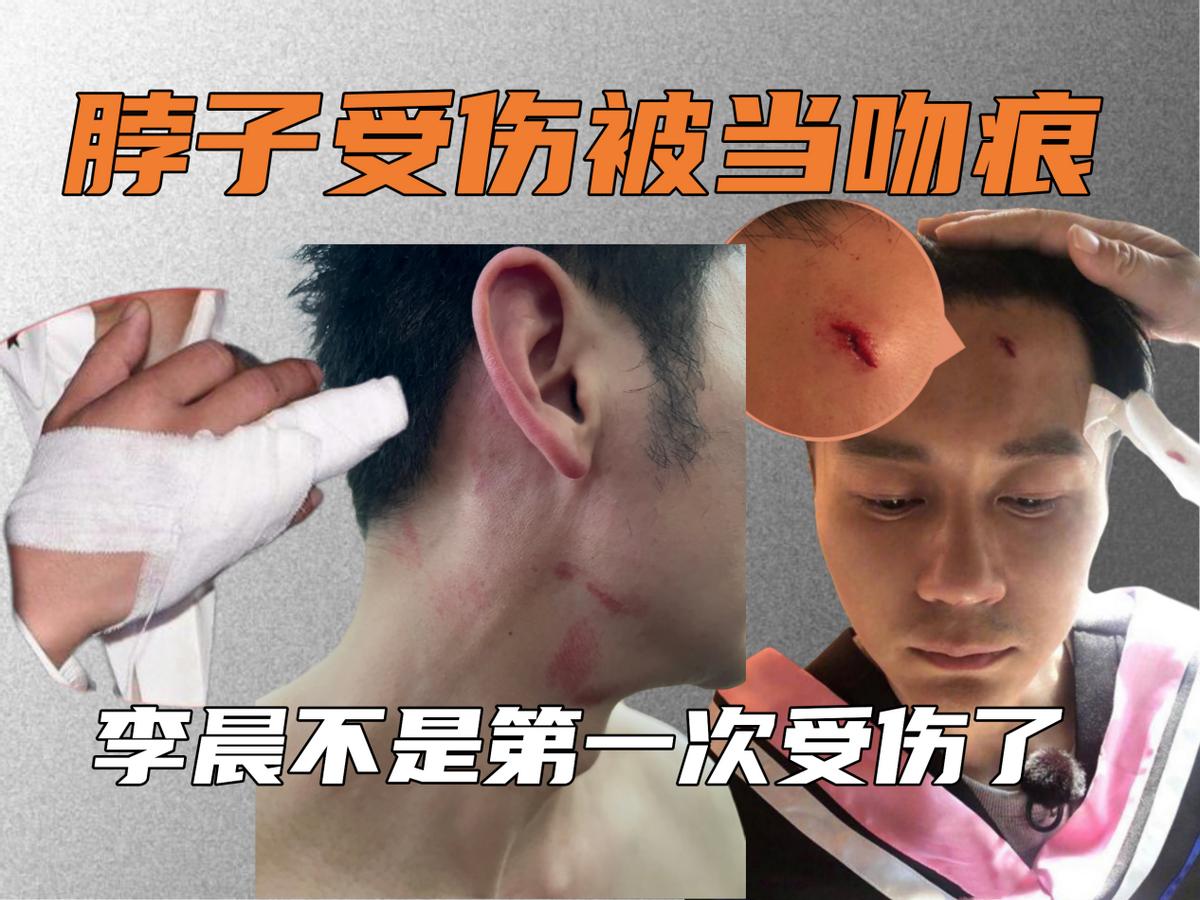 Li Chen's neck injury was treated as a hickey, the studio denies it ...