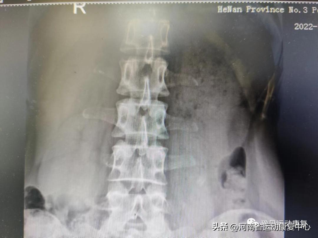 Is back pain a lumbar muscle strain? - iNEWS