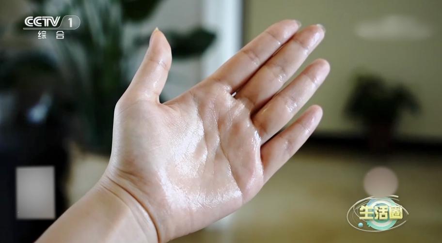 What to do with sweaty hands and feet? - iMedia