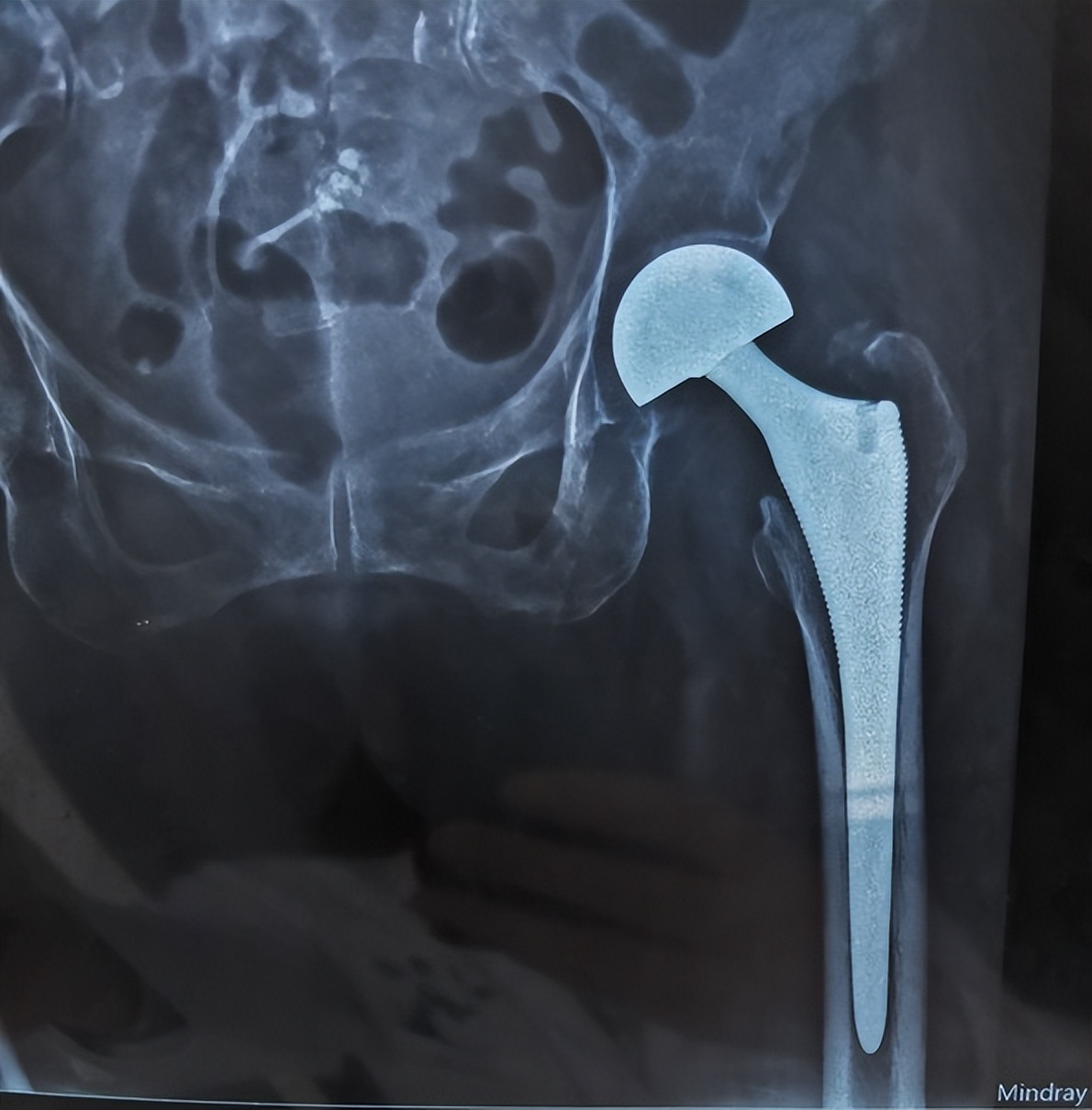 Half Hip Replacement or Total Hip Replacement? What is "half" and what ...
