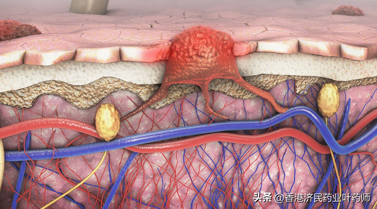 Neoadjuvant combined immunotherapy Opdualag in resectable melanoma - iNEWS