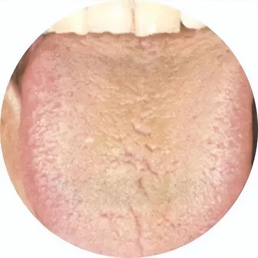 Once this signal appears on the tongue: go to the hospital immediately ...