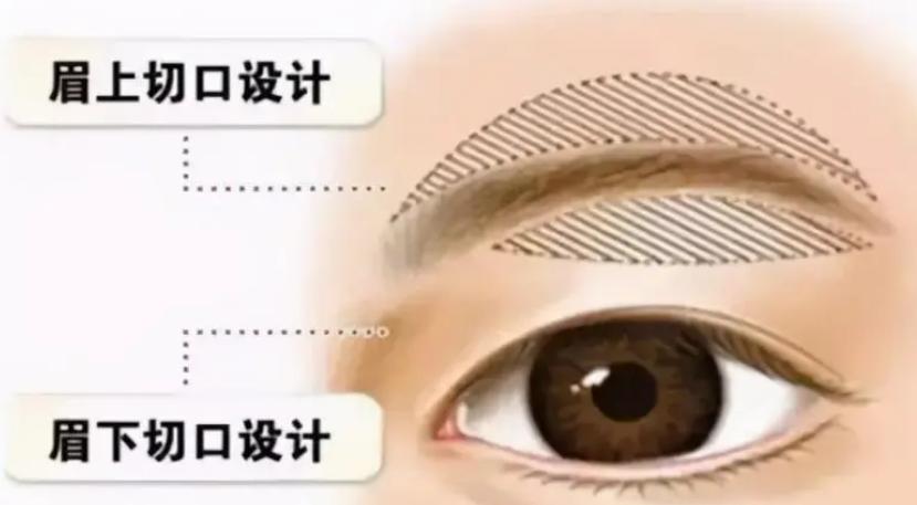 Droopy eyelids look 10 years older!How to choose eyebrow lift and ...