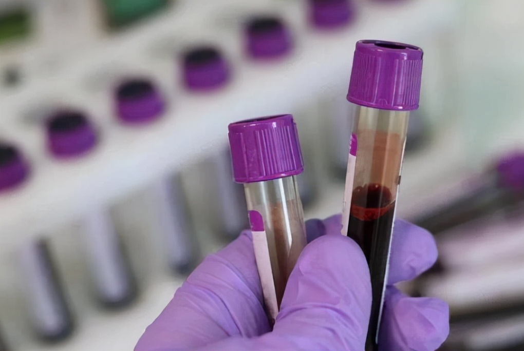 Can a routine blood test detect cancer?Don't be too careless if the 3 ...