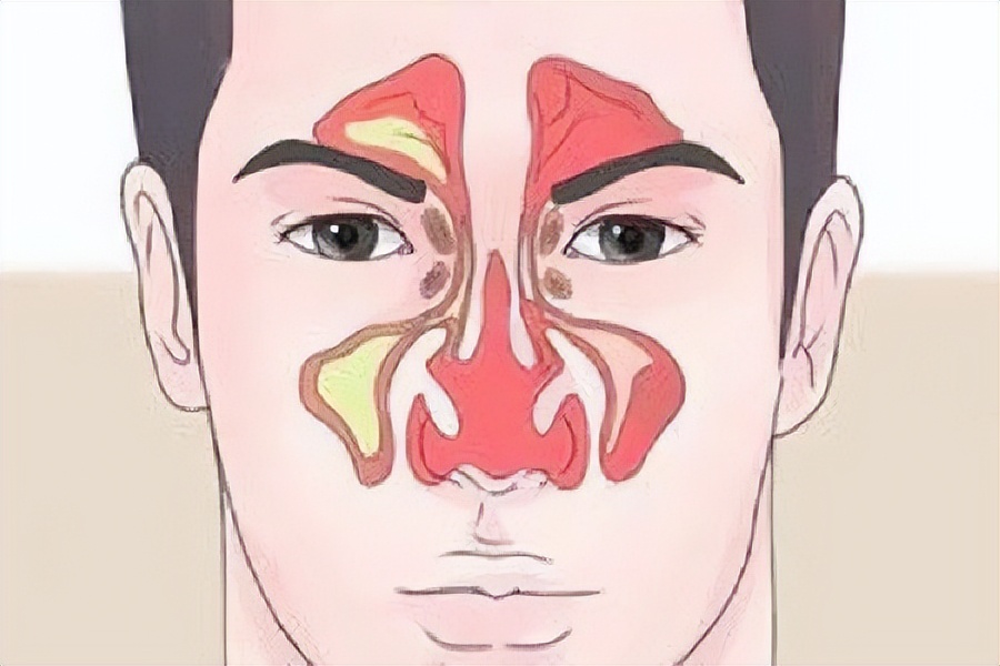 Acute sinusitis of small stones learning the five senses - iNEWS